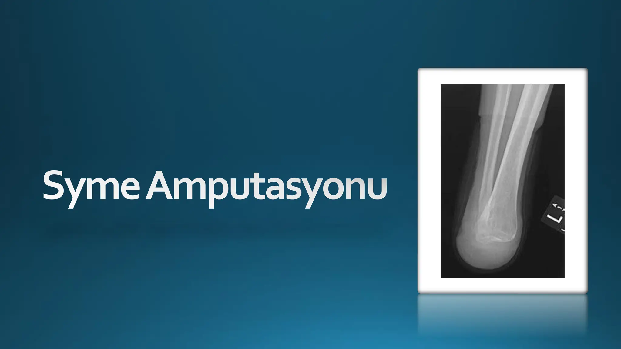 syme amputasyon.pdf described and fully explained | PPT