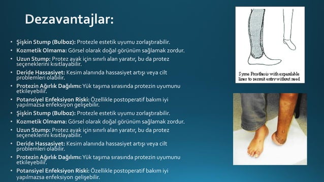 syme amputasyon.pdf described and fully explained | PPT