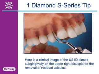 Symmetry Piezo Tips | PPT | Oral care | Personal Care