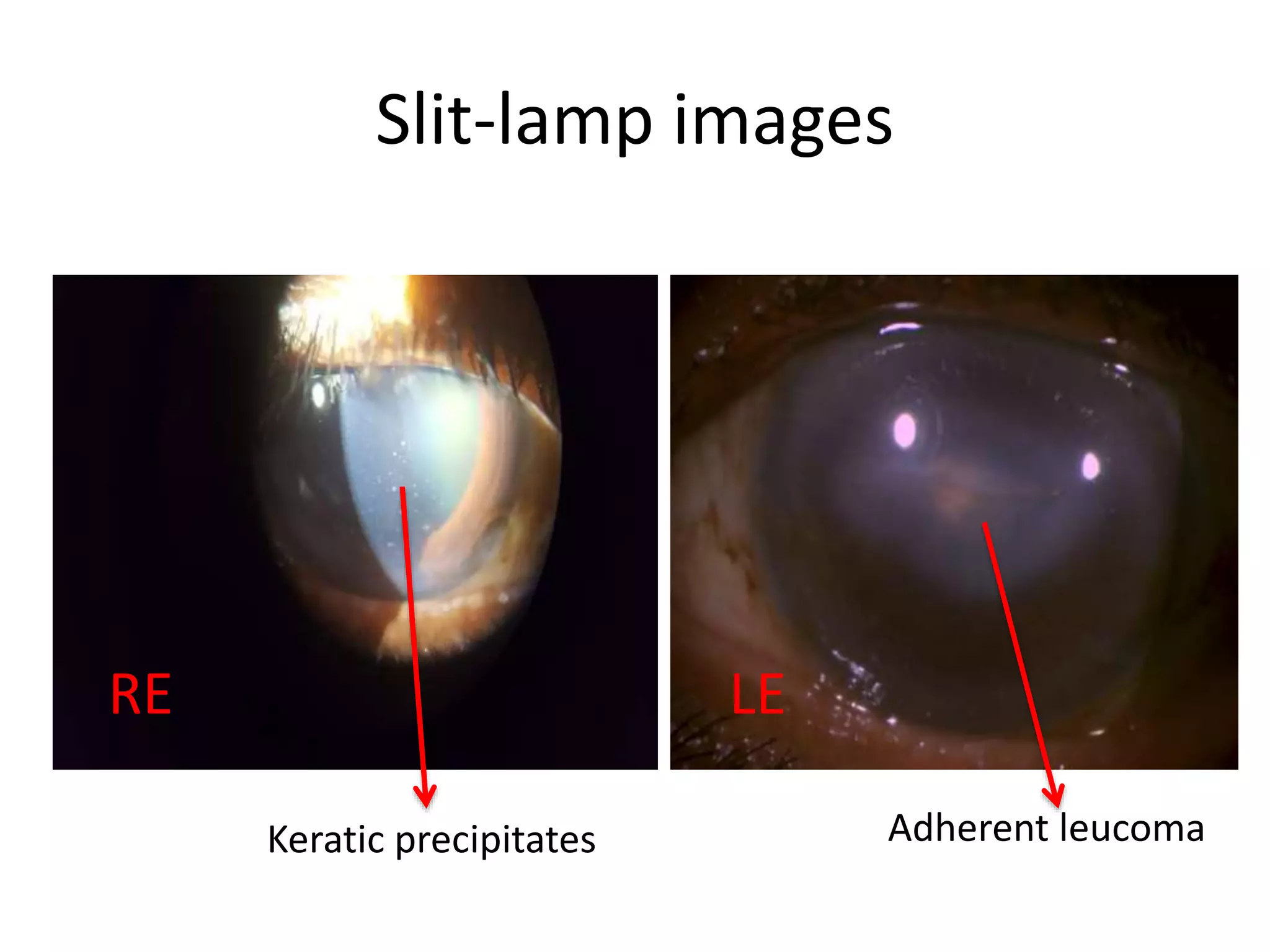 Sympathetic ophthalmia | PPTX