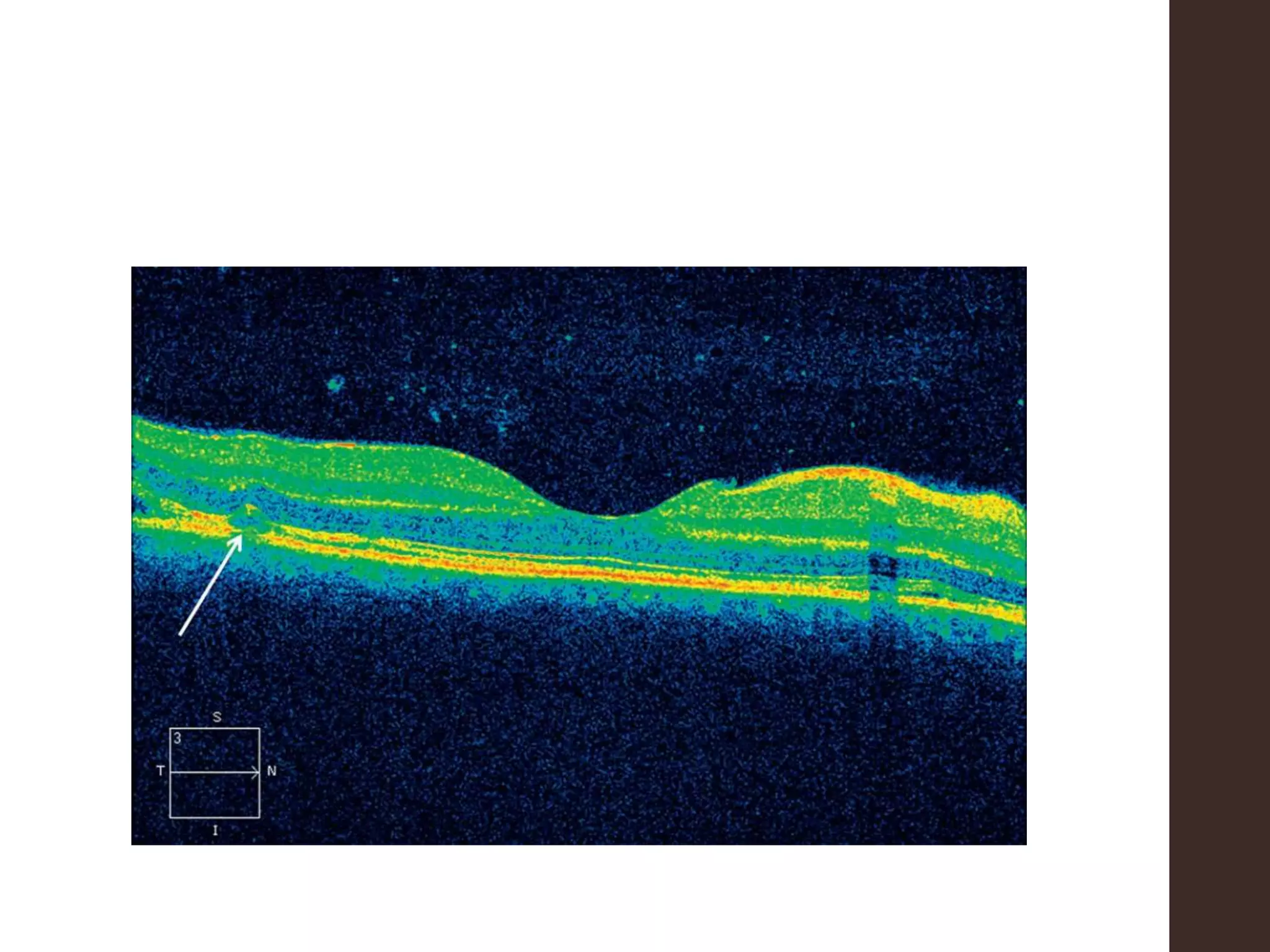 Sympathetic ophthalmitis | PPTX
