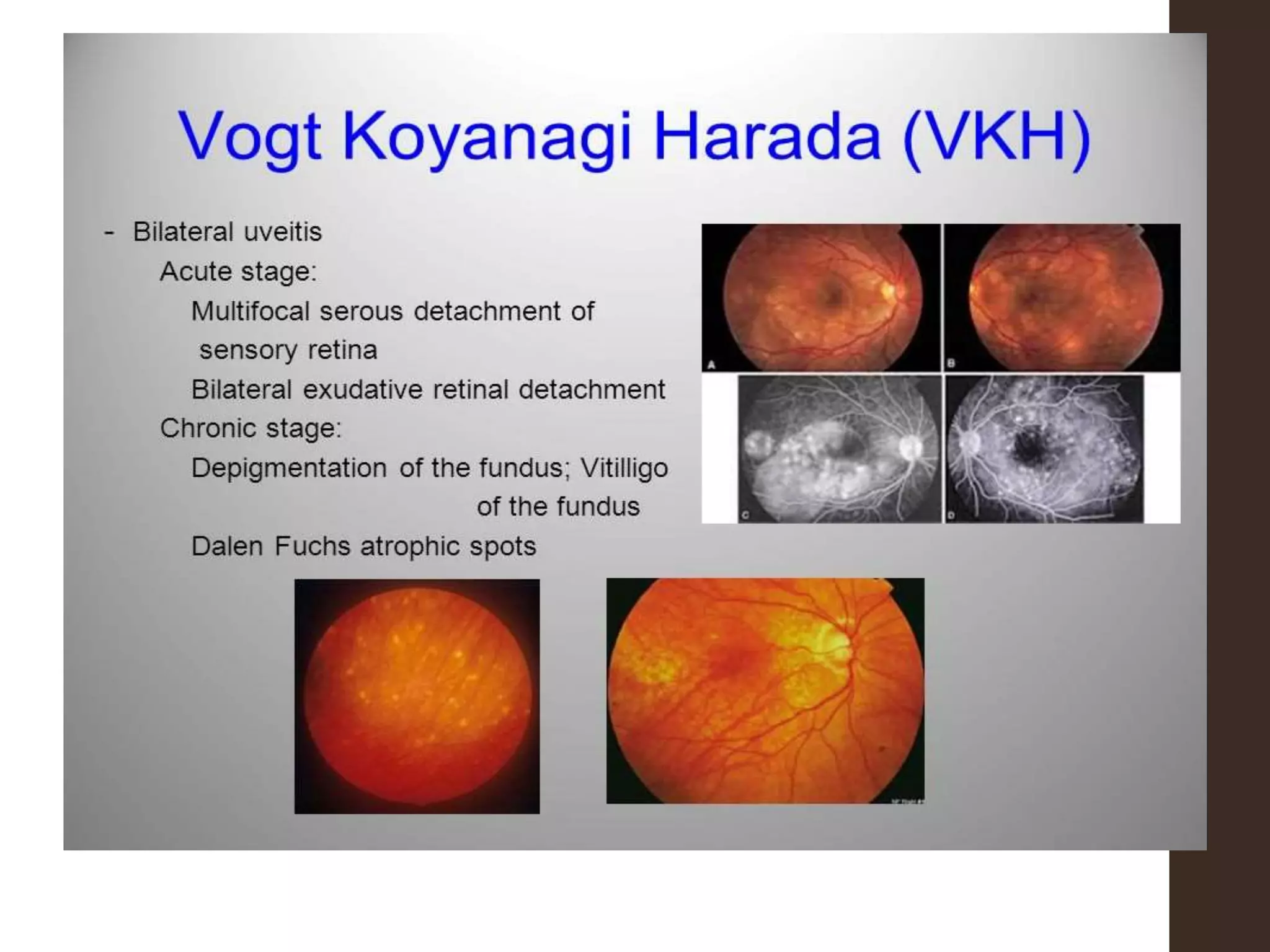 Sympathetic ophthalmitis | PPTX