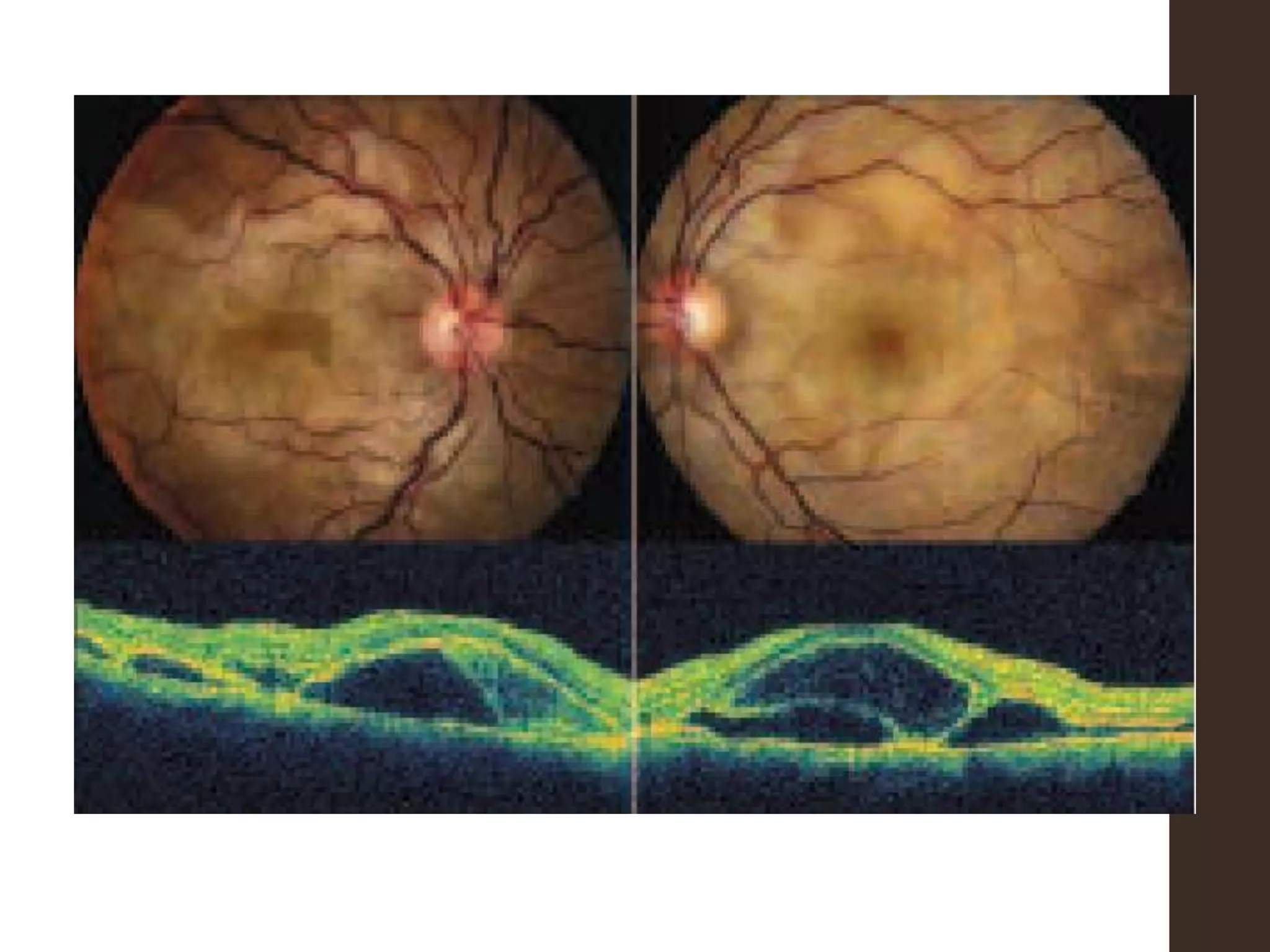 Sympathetic ophthalmitis | PPTX