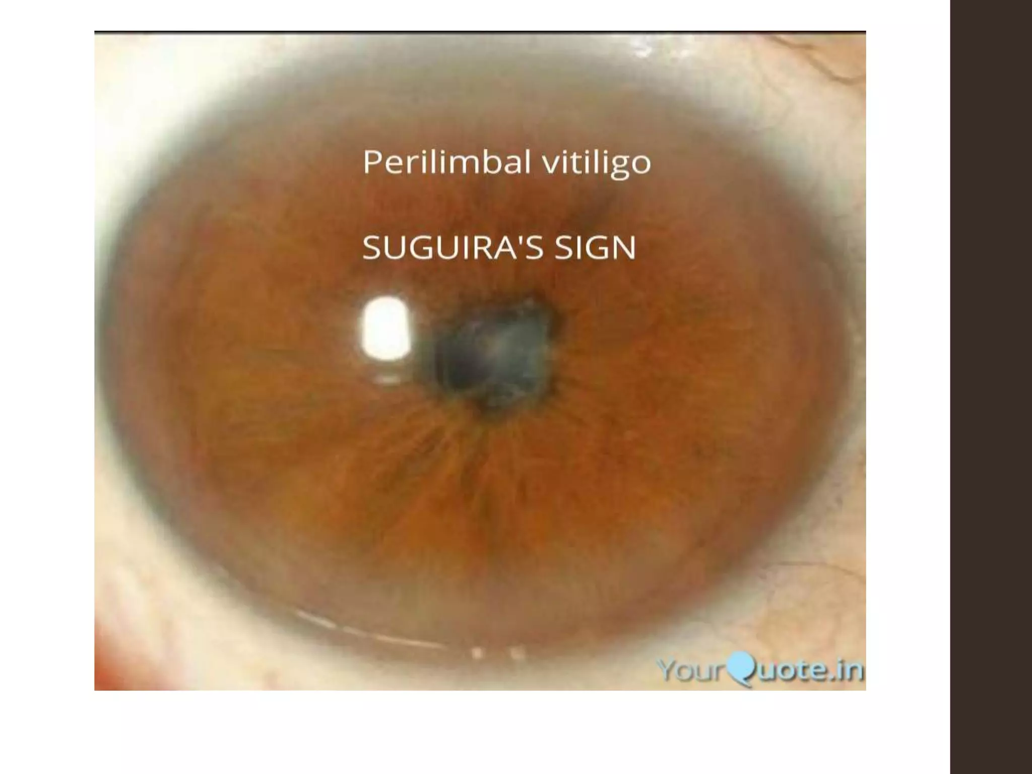 Sympathetic ophthalmitis | PPTX