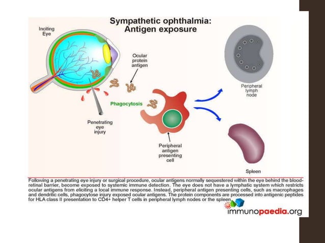 Sympathetic ophthalmitis | PPTX