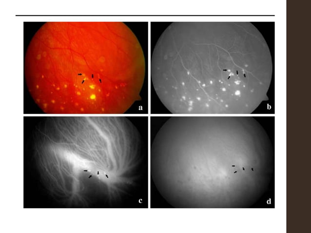 Sympathetic ophthalmitis | PPTX