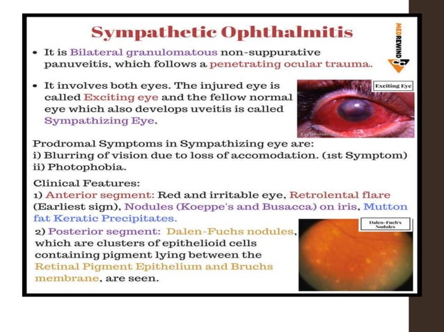 Sympathetic ophthalmitis | PPTX