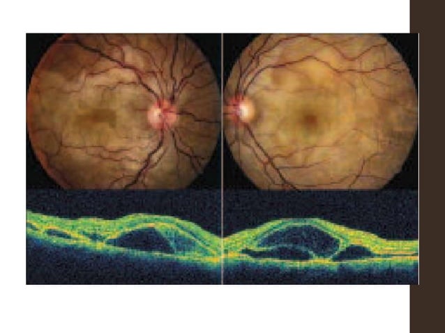 Sympathetic ophthalmitis | PPTX