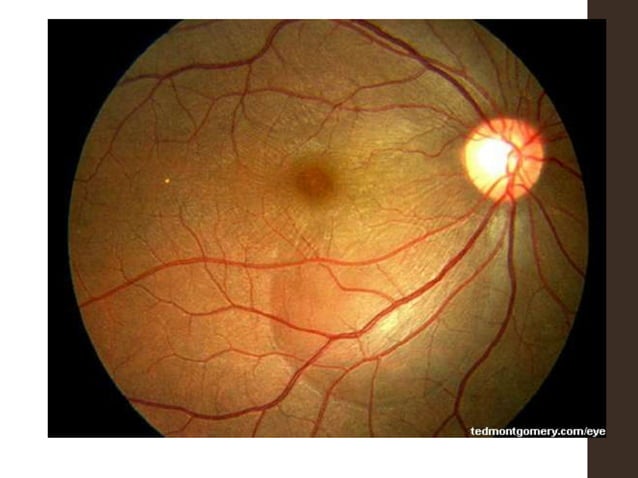 Sympathetic ophthalmitis | PPTX