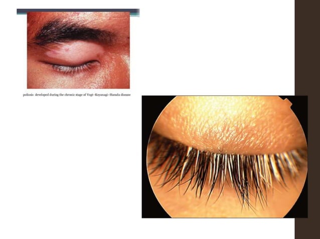 Sympathetic ophthalmitis | PPTX