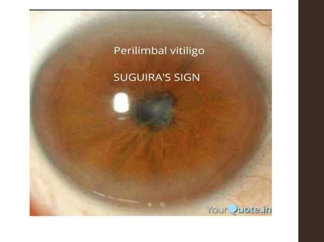 Sympathetic ophthalmitis | PPTX