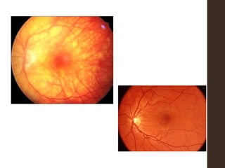 Sympathetic ophthalmitis | PPTX