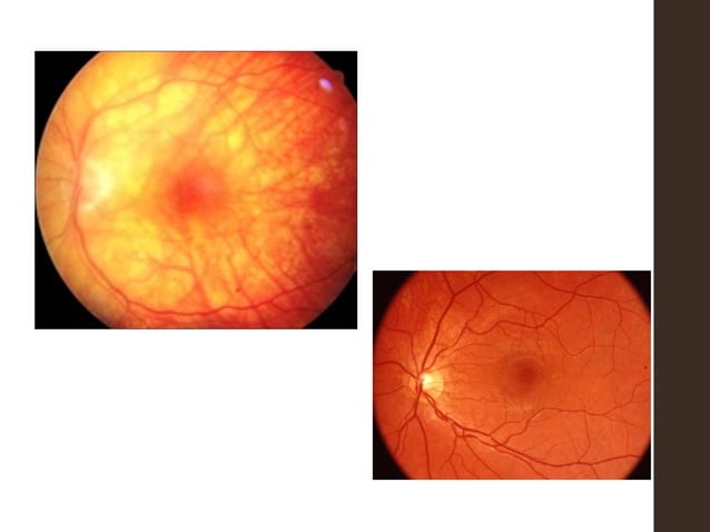 Sympathetic ophthalmitis | PPTX