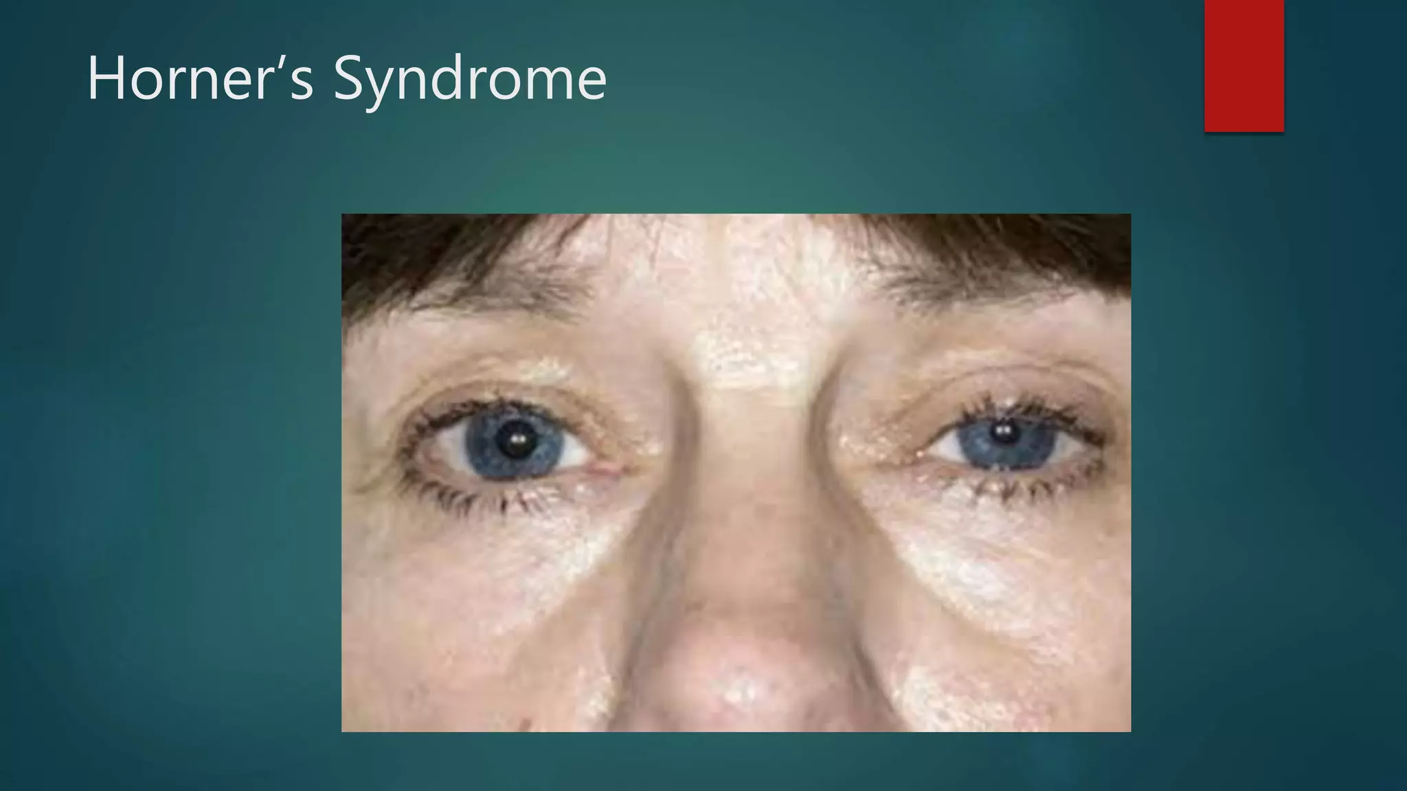 Sympathetic supply to eyeball and Horner syndrome | PPTX