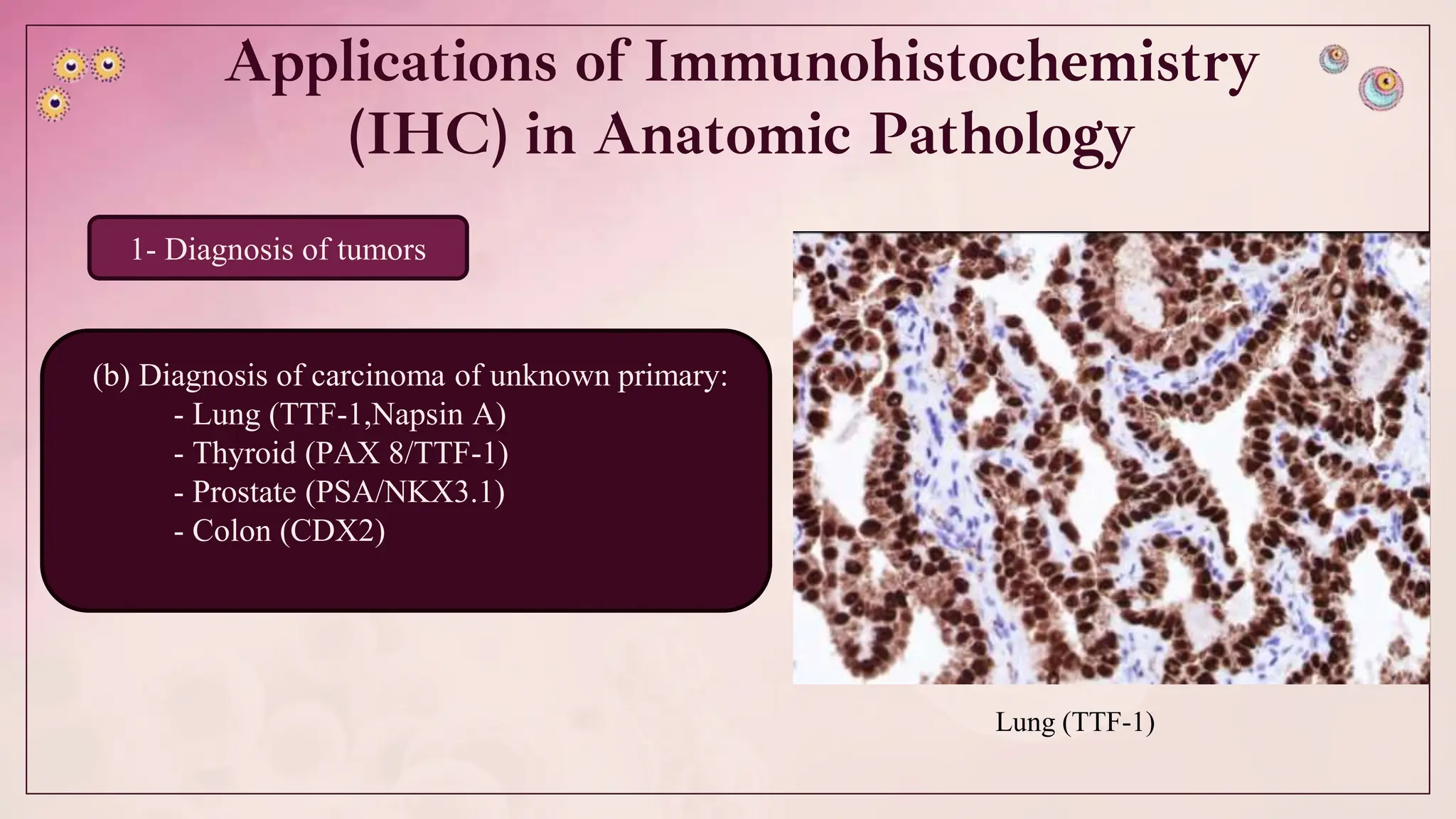 IHC in cancer diagnosis | PPTX