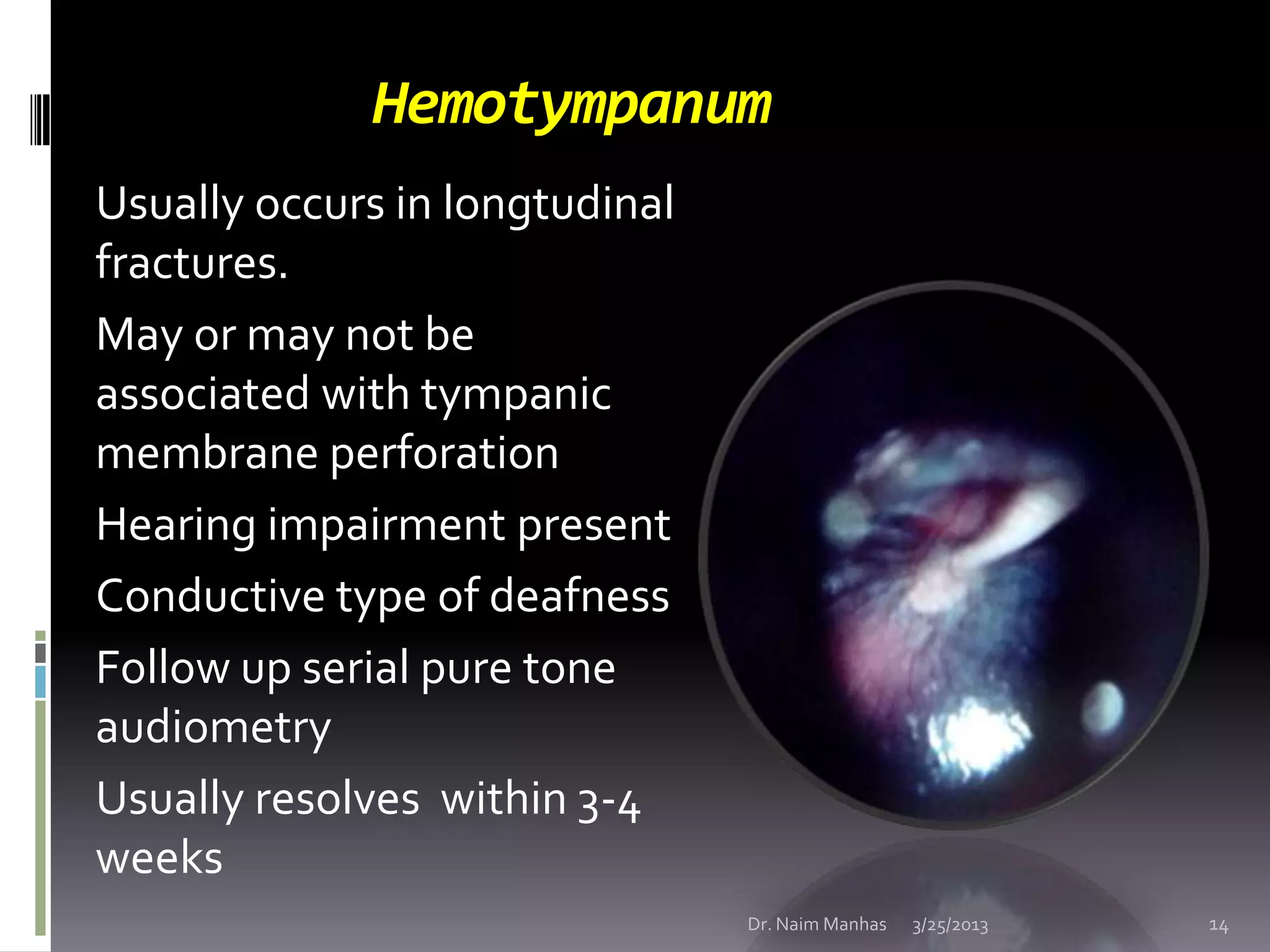 temporal bone fractures | PPTX