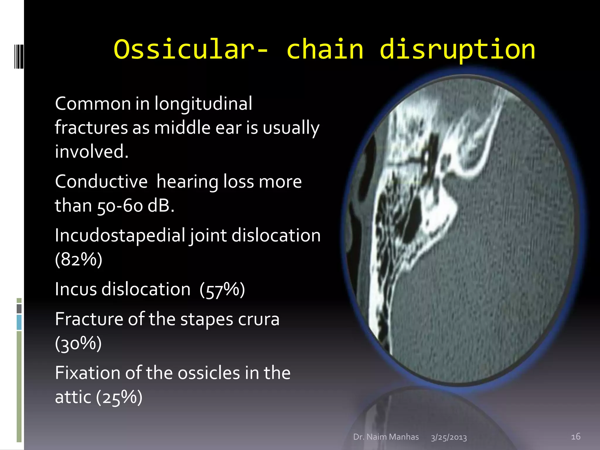 temporal bone fractures | PPTX