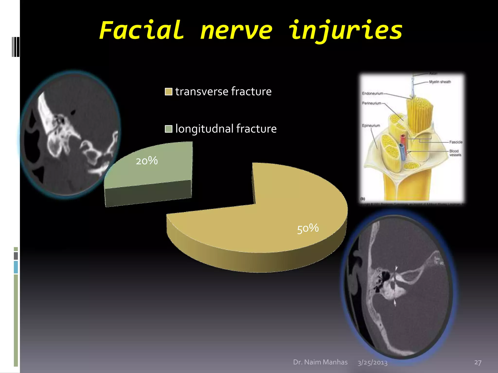 temporal bone fractures | PPTX