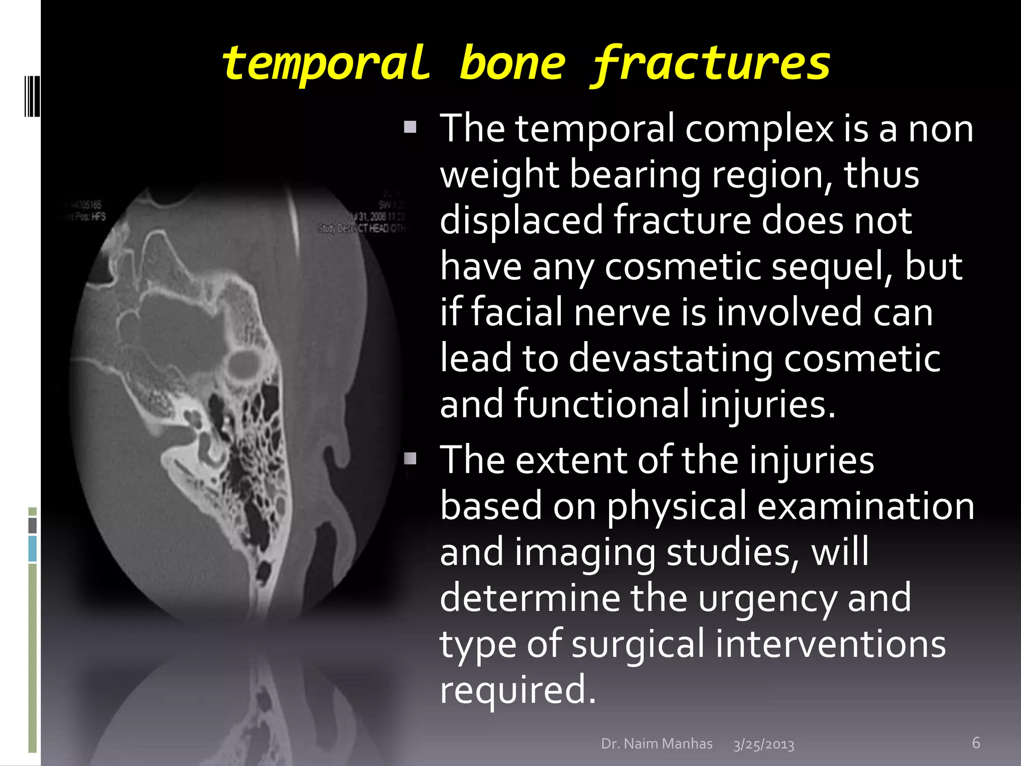 temporal bone fractures | PPTX