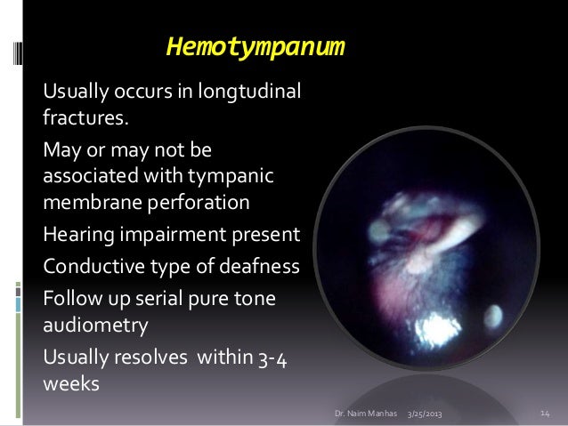 temporal bone fractures