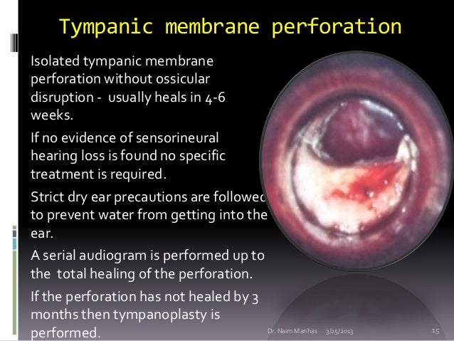 temporal bone fractures