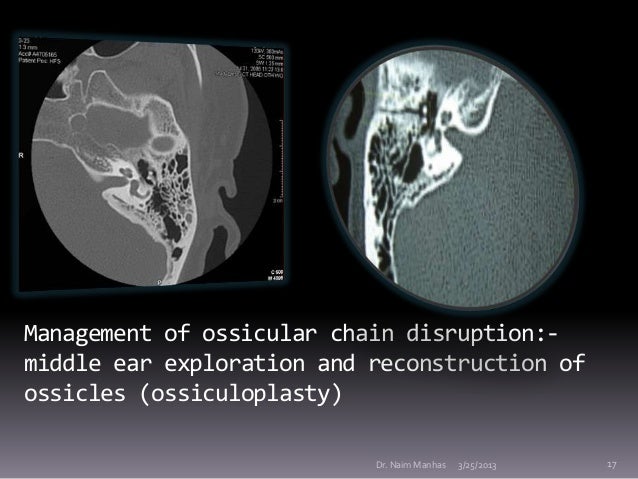temporal bone fractures