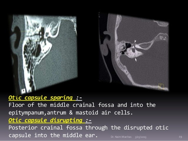 temporal bone fractures