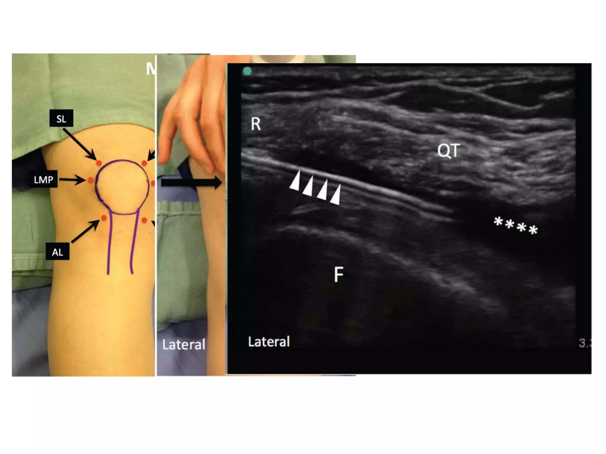 Ultrasound Guided Botulinum Toxin Injection and Nerve Block for ...