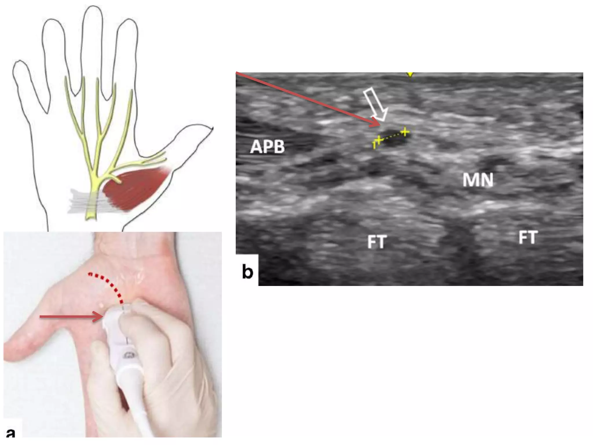 Ultrasound Guided Botulinum Toxin Injection and Nerve Block for ...