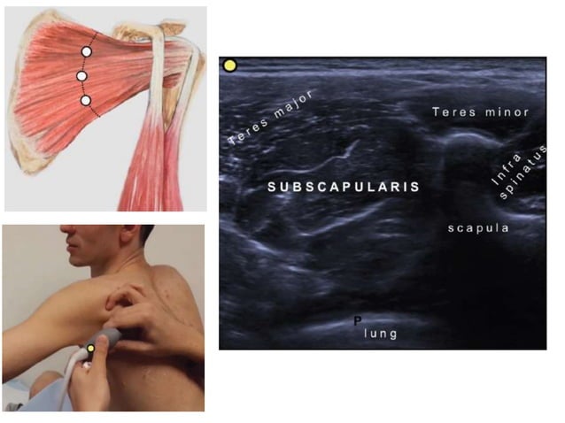 Ultrasound Guided Botulinum Toxin Injection and Nerve Block for ...