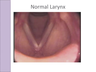 Symposium Vocal Nodules And Polyp | PPT