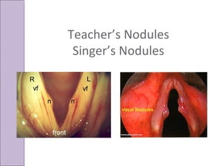 Symposium Vocal Nodules And Polyp | PPT