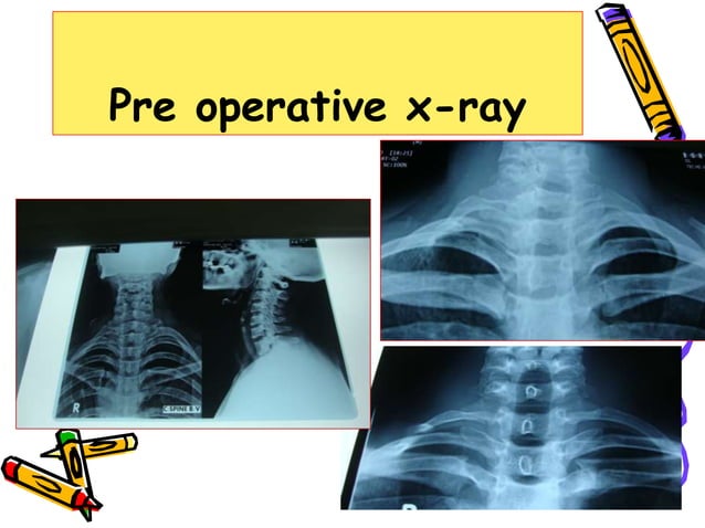 Symptomatic cervical rib surgery | PPT | Bone and Joint Conditions ...