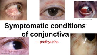 Symptomatic conditions of conjunctiva | PPT