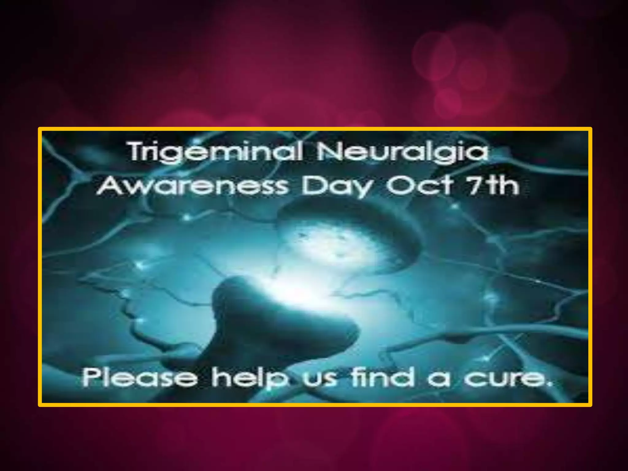 Symptomatology and pathophysiology of trigeminal neuralgia copy | PPTX