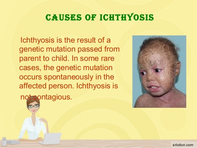 Get To Know More About Symptoms Of Ichthyosis