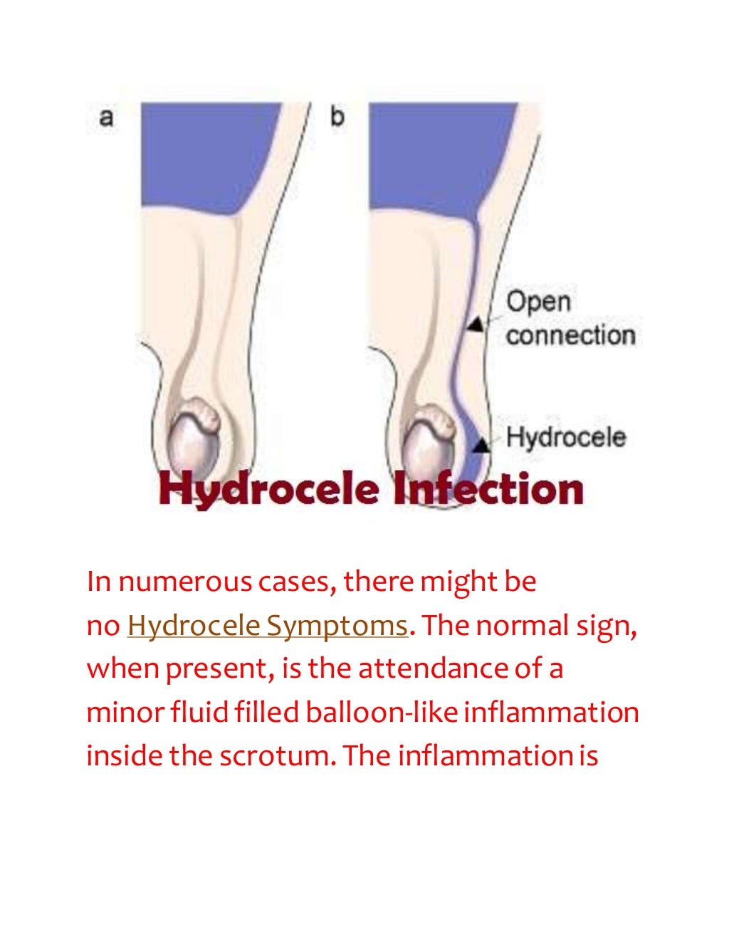 Symptoms And Treatment Technique Of Hydrocele Infection