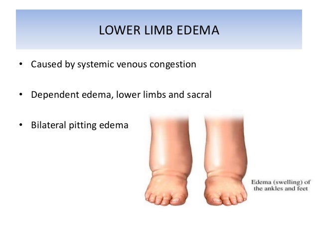 Heart Disease Edema Legs Cardiovascular Disease