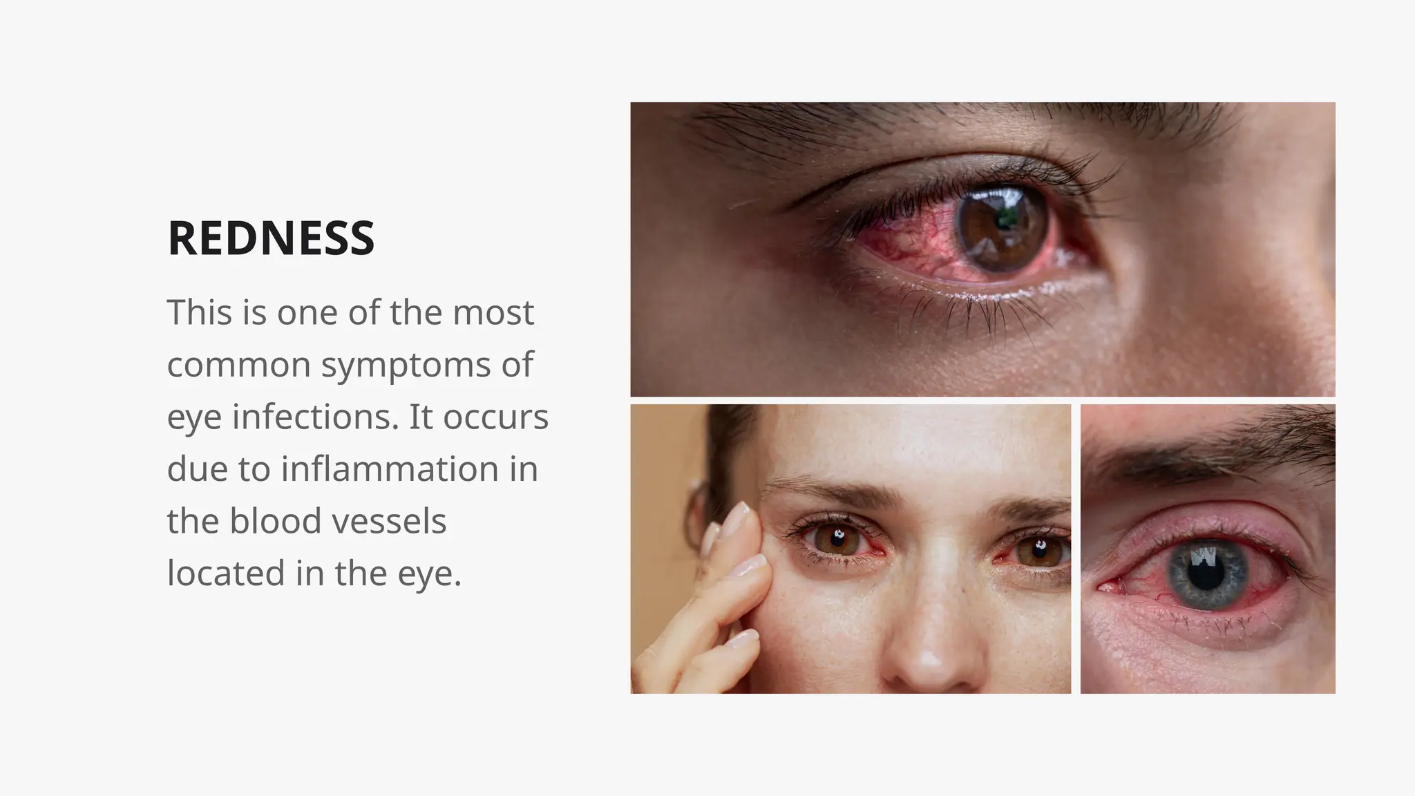 Eye Infection Symptoms You Shouldn't Ignore | PPTX | Eye and Vision ...