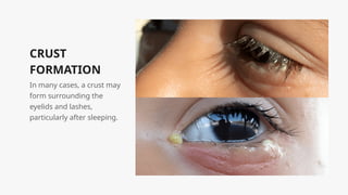 Eye Infection Symptoms You Shouldn't Ignore | PPTX