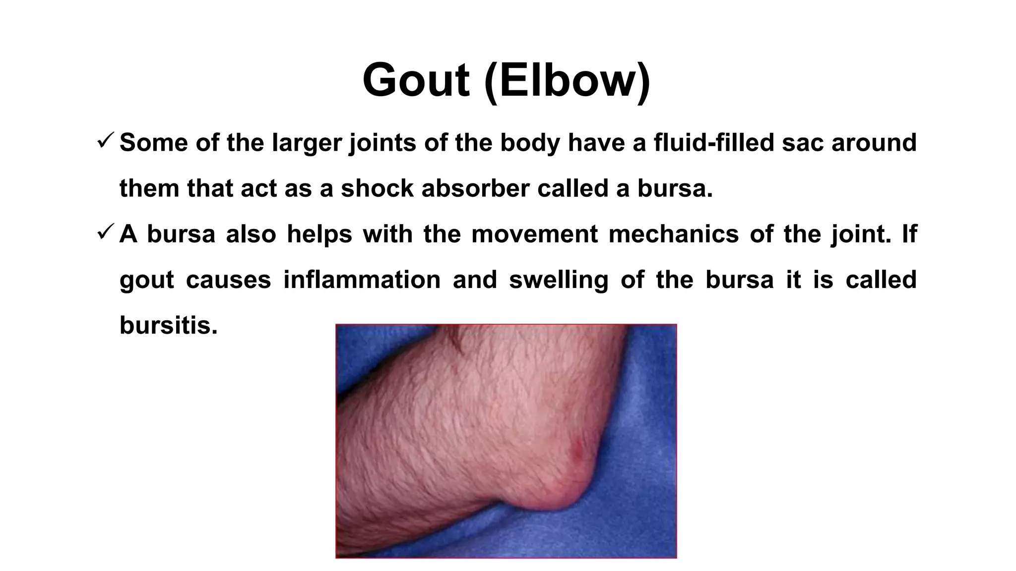 Symptoms of gout | PPT