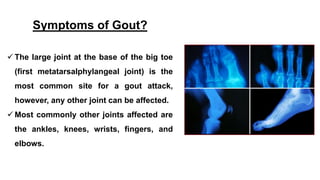 Symptoms of gout | PPTX