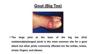 Symptoms of gout | PPTX