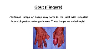 Symptoms of gout | PPTX