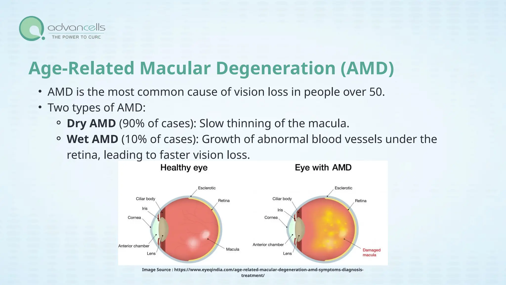 Symptoms of Macular Degeneration and Age-Related Macular Degeneration ...
