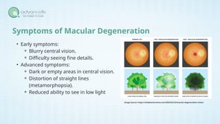 Symptoms of Macular Degeneration and Age-Related Macular Degeneration ...
