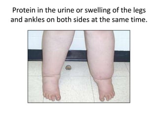 Symptoms Of Systemic Lupus Erythematosus | PPT