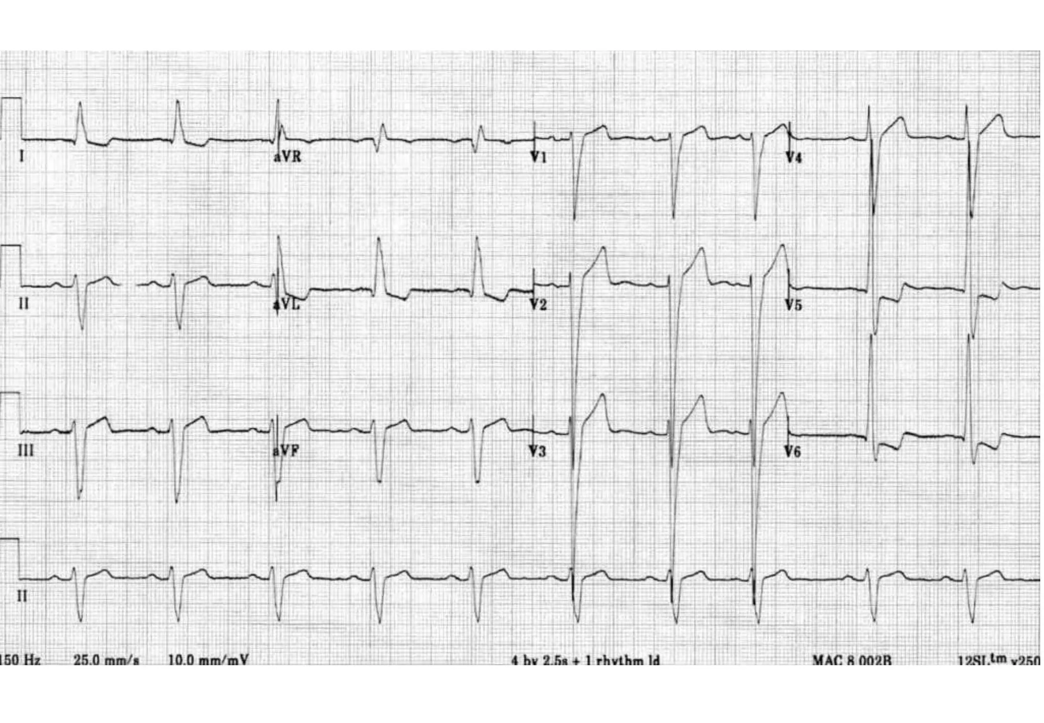 Syncope 1 aortic stenosis | PPTX