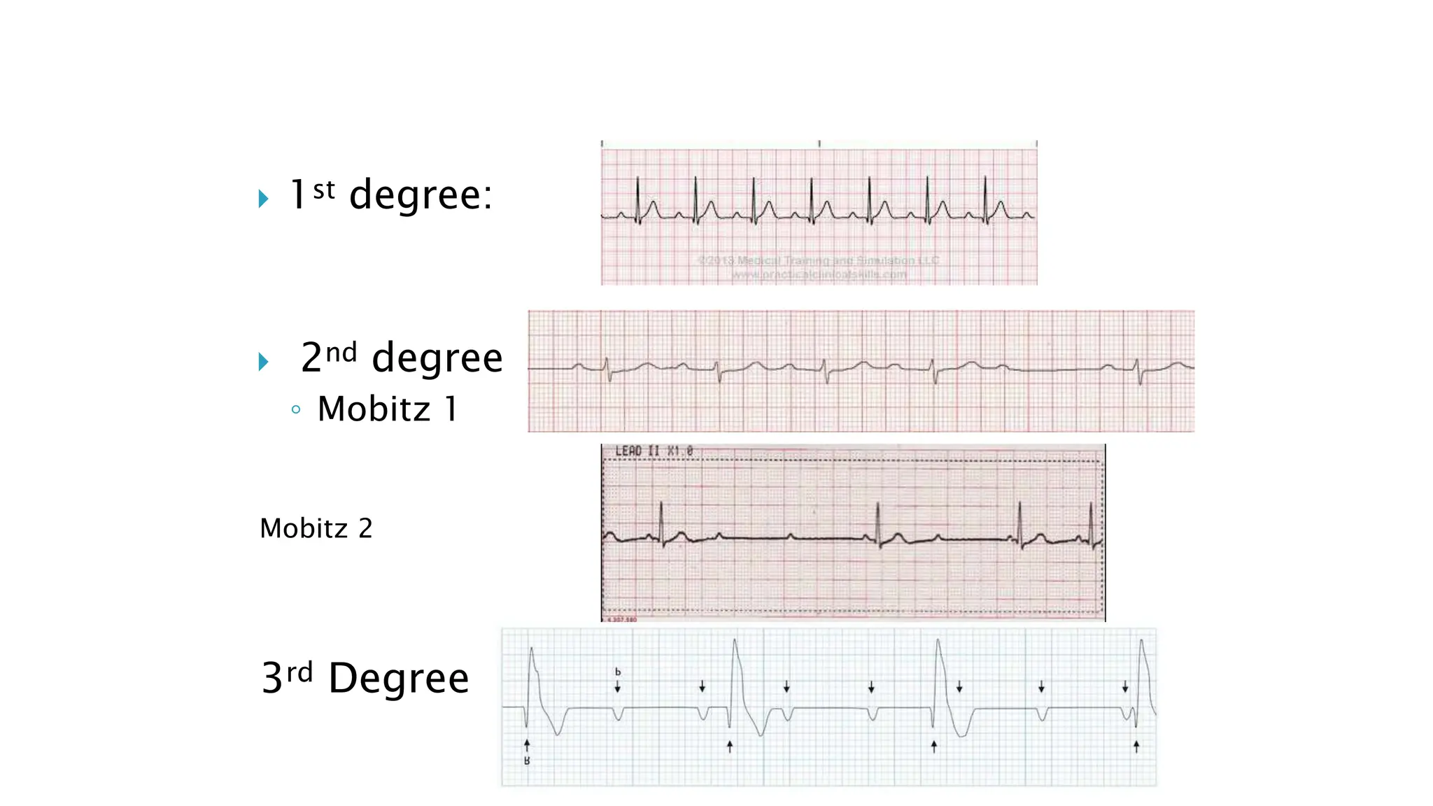 syncope and electrocardiogram powerpoint presentation | PPTX