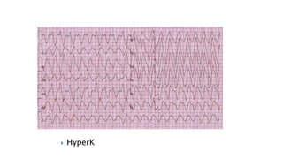 syncope and electrocardiogram powerpoint presentation | PPT